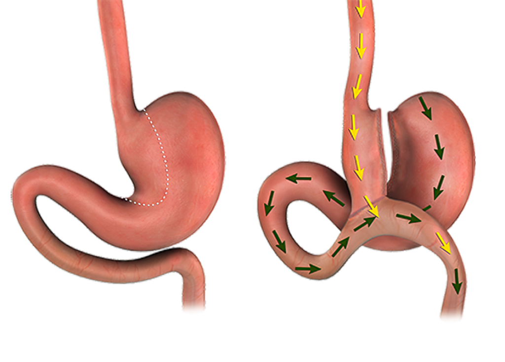 Is the Omega Loop Gastric Bypass Right for You? - Mind Setters