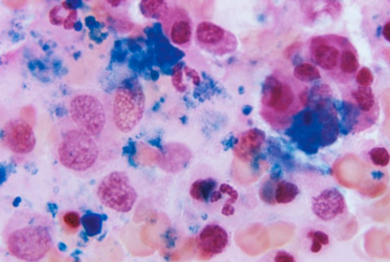 Learn about the Three Different Types of Bone Marrow Transplants and ...