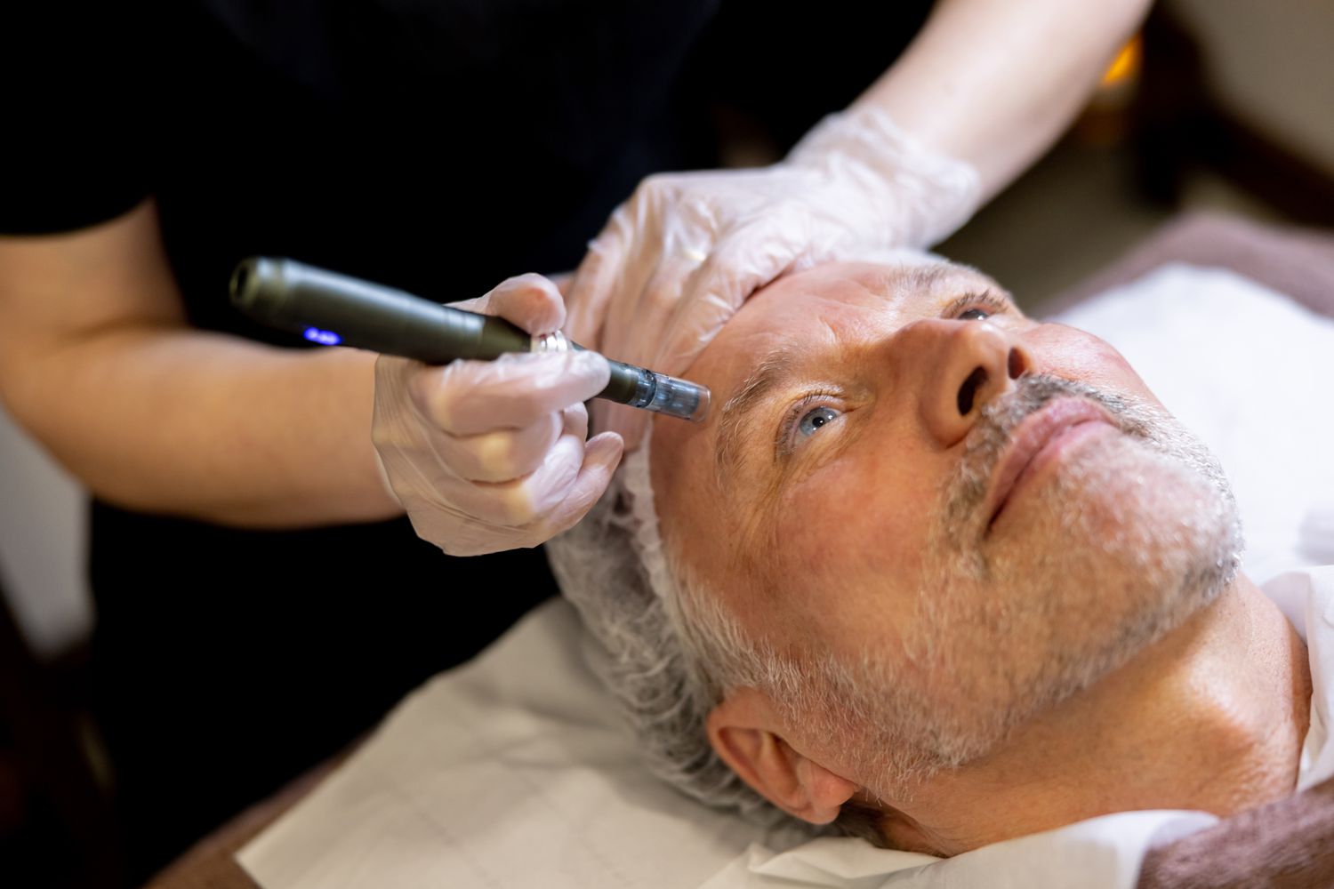 Microneedling: A revolution in skin rejuvenation - Mind Setters